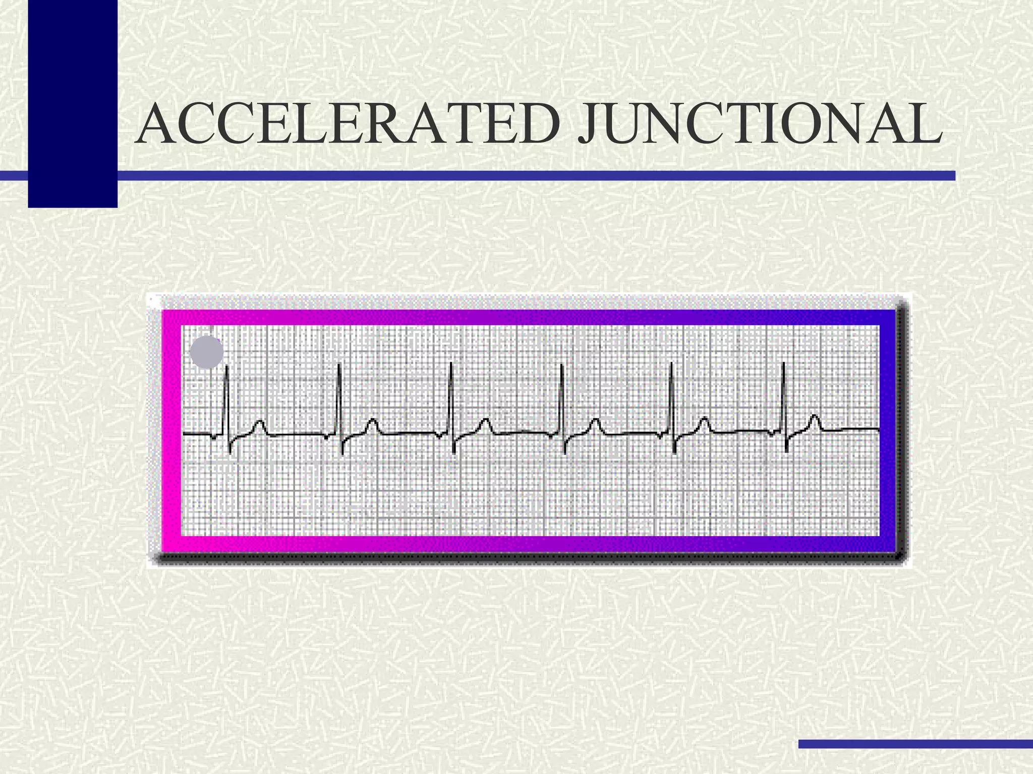 Basic Rhythm Strip Review | PPT