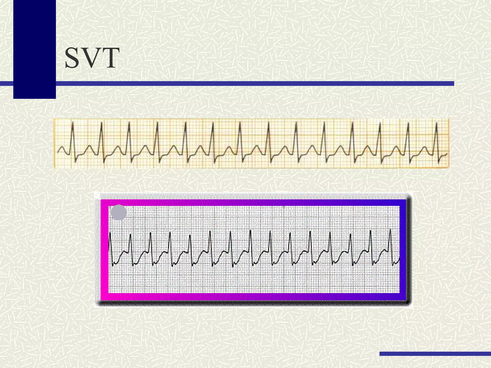 Basic Rhythm Strip Review | PPT