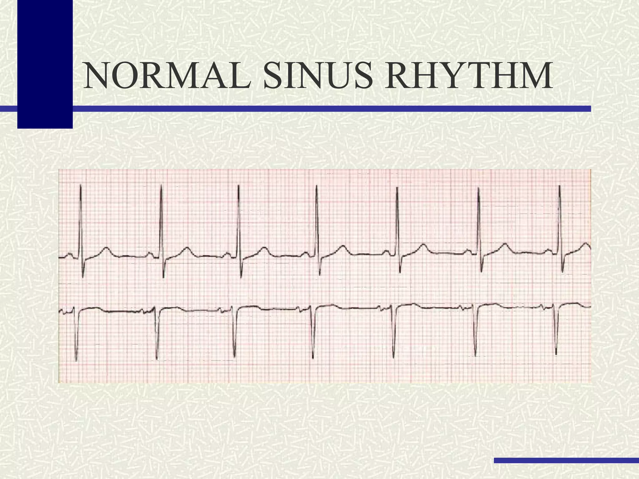 Basic Rhythm Strip Review | PPT