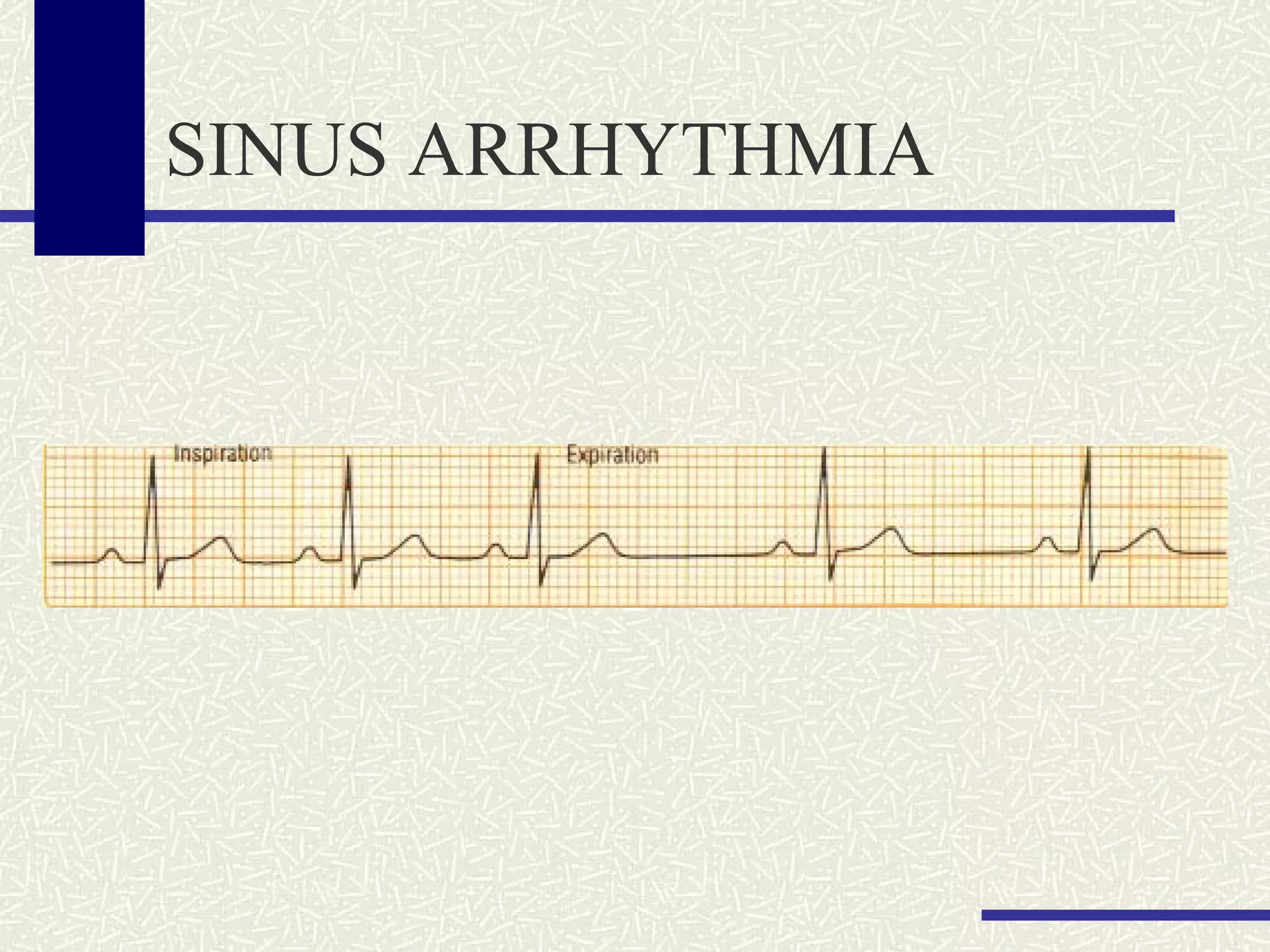 Basic Rhythm Strip Review | PPT