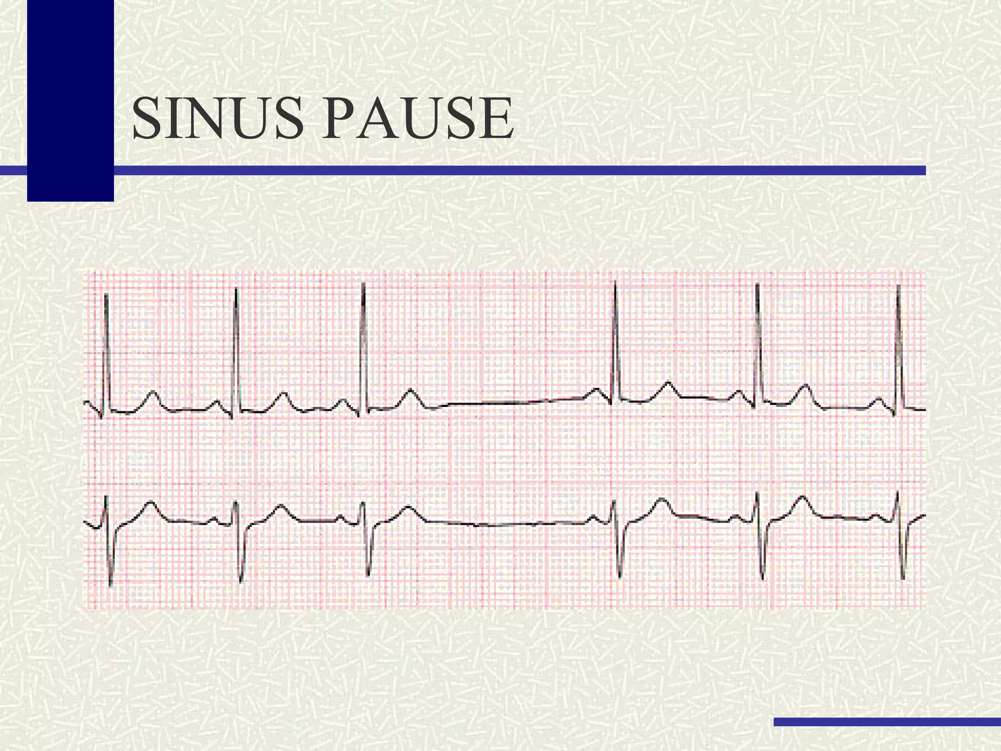 Basic Rhythm Strip Review | PPT