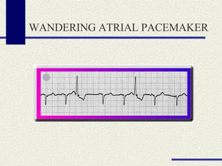 Pacemaker Rhythm Strips