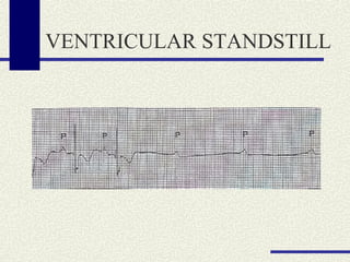 Ventricular Standstill Strips