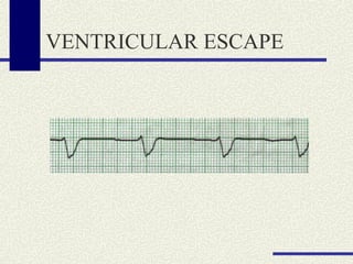 Ventricular Escape Rhythm Strip