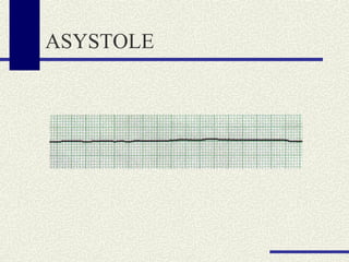 Asystole Rhythm Strip