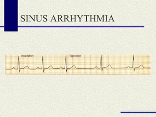 Sinus Arrhythmia Rhythm Strip
