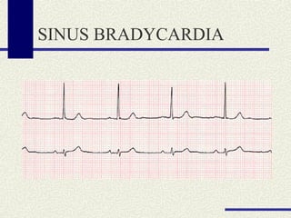 Sinus Bradycardia Rhythm Strip