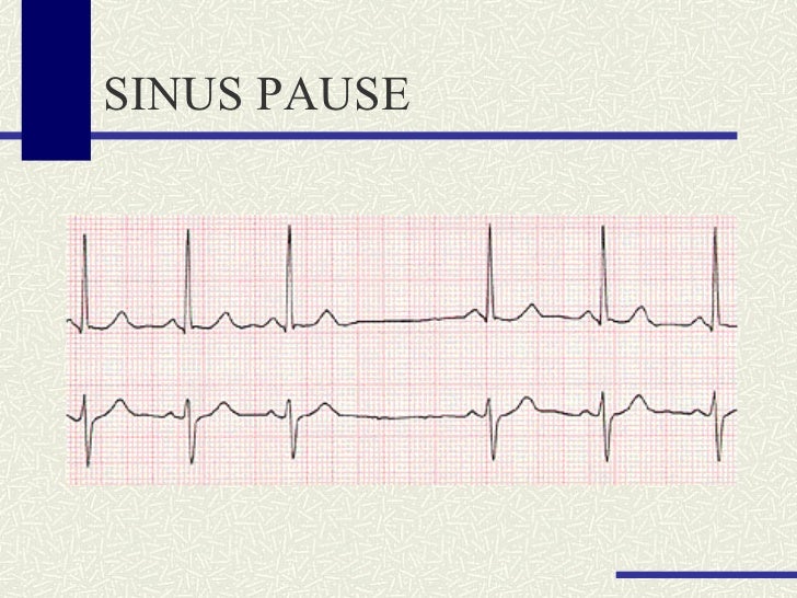 Basic Rhythm Strip Review