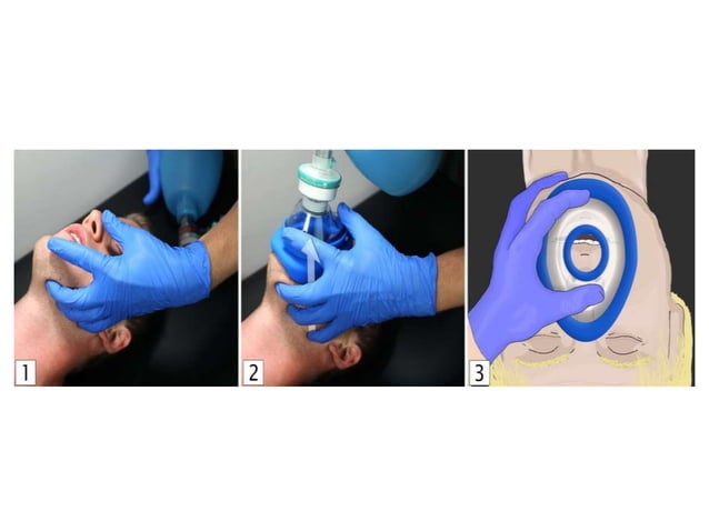 Basic Airway management.pptx | First Aid | Injuries