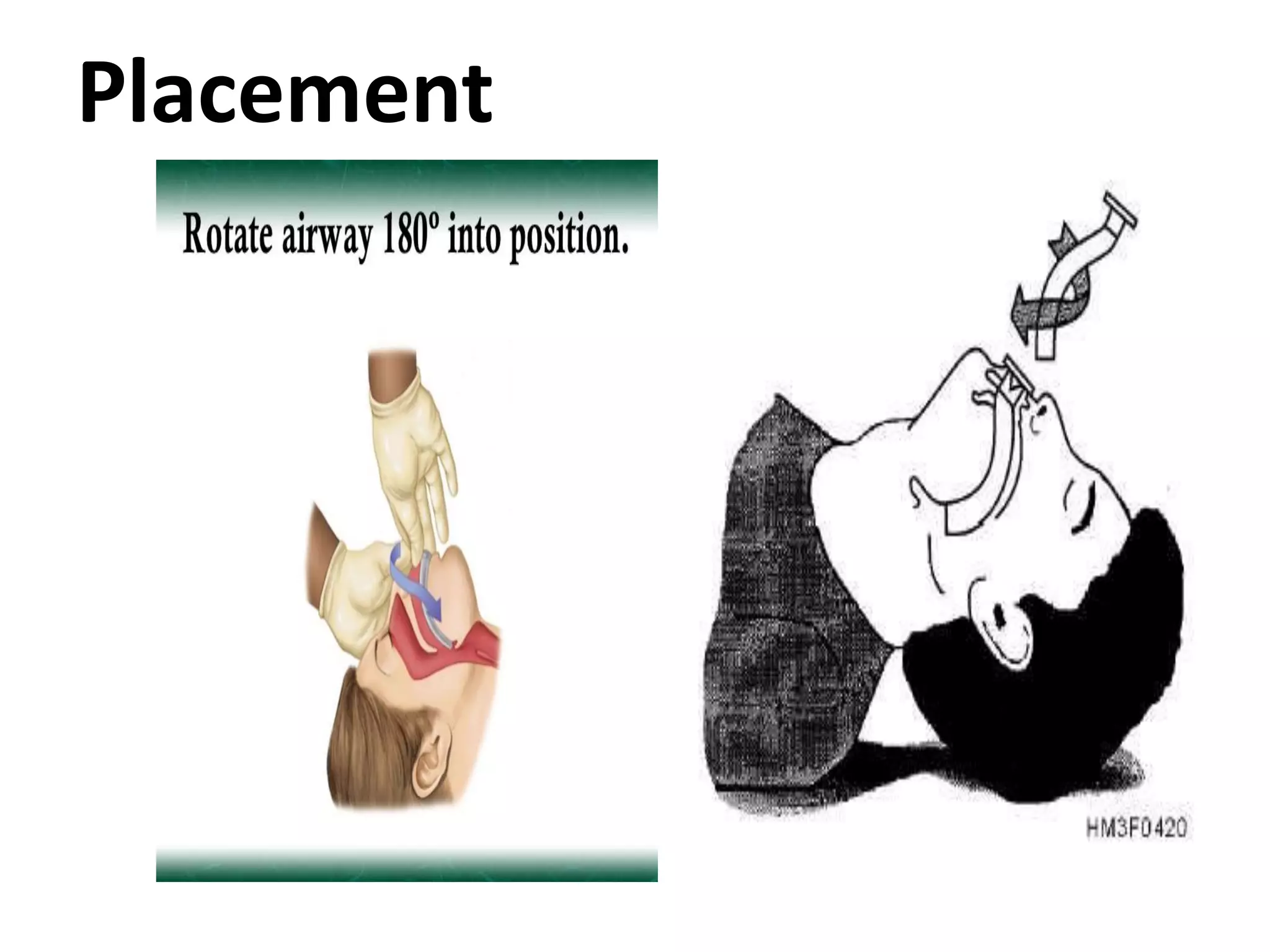 Basic airway management | PDF