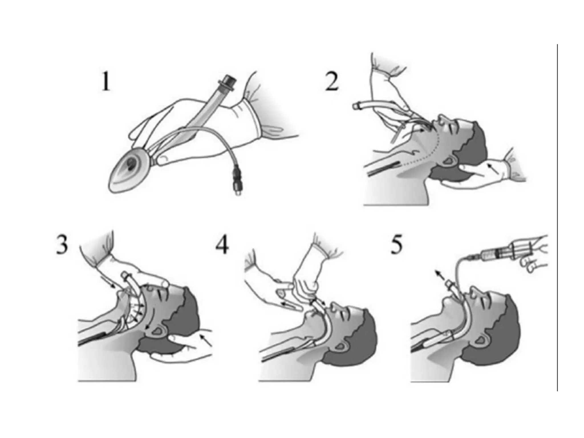 Basic airway management | PDF
