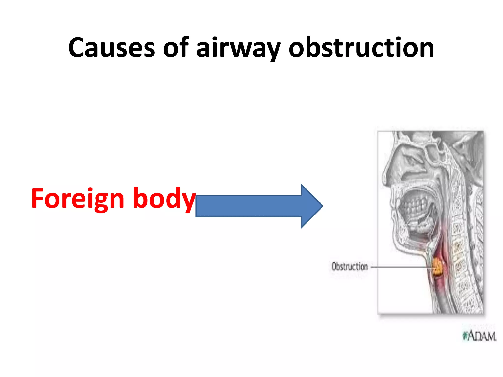 Basic airway management | PDF