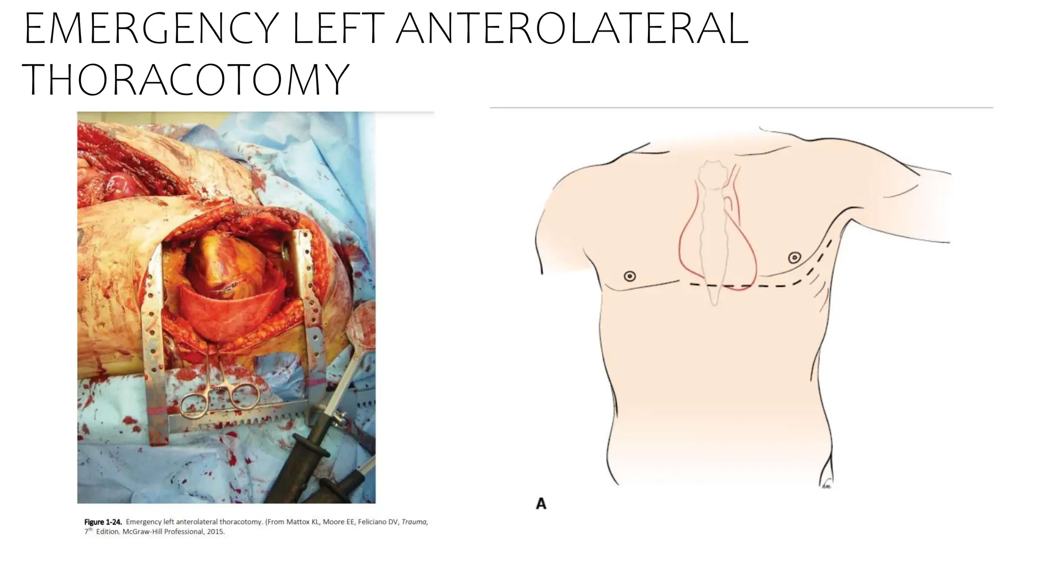 basic anatomi for toracic surgery 1.pptx