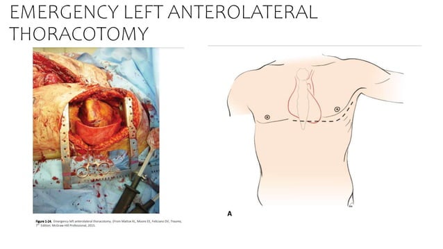 basic anatomi for toracic surgery 1.pptx