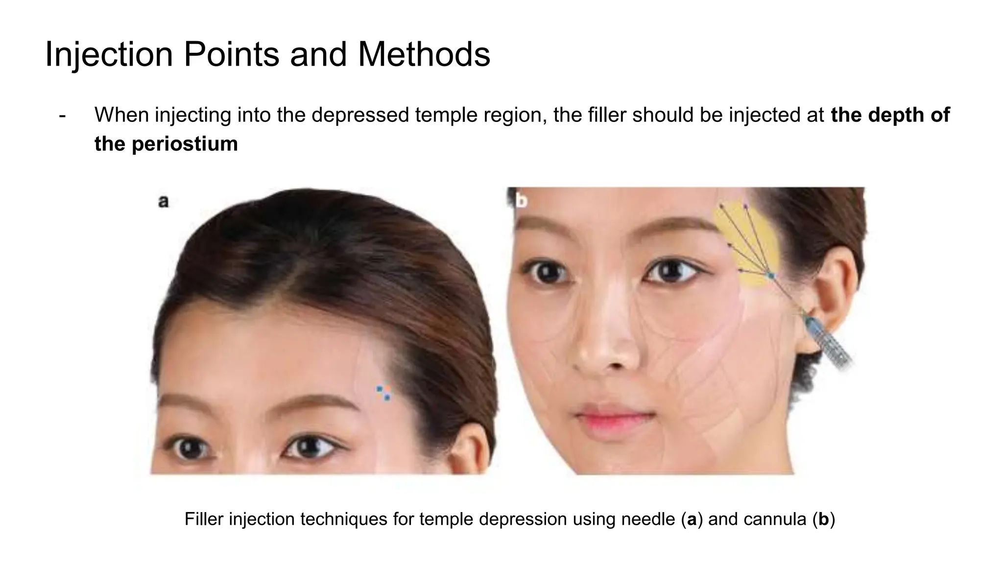 Basic Anatomy of the tear trough area .pptx