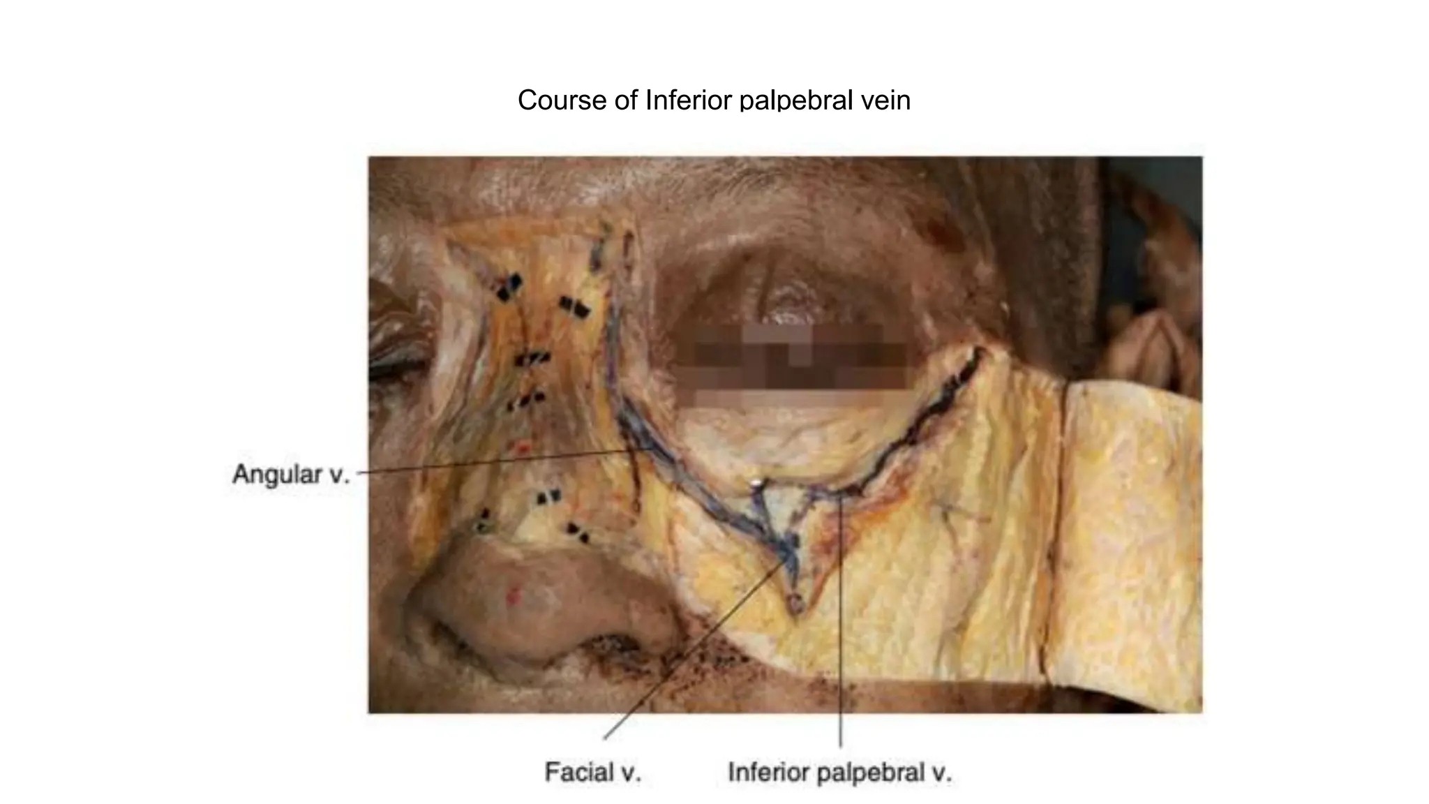 Basic Anatomy of the tear trough area .pptx