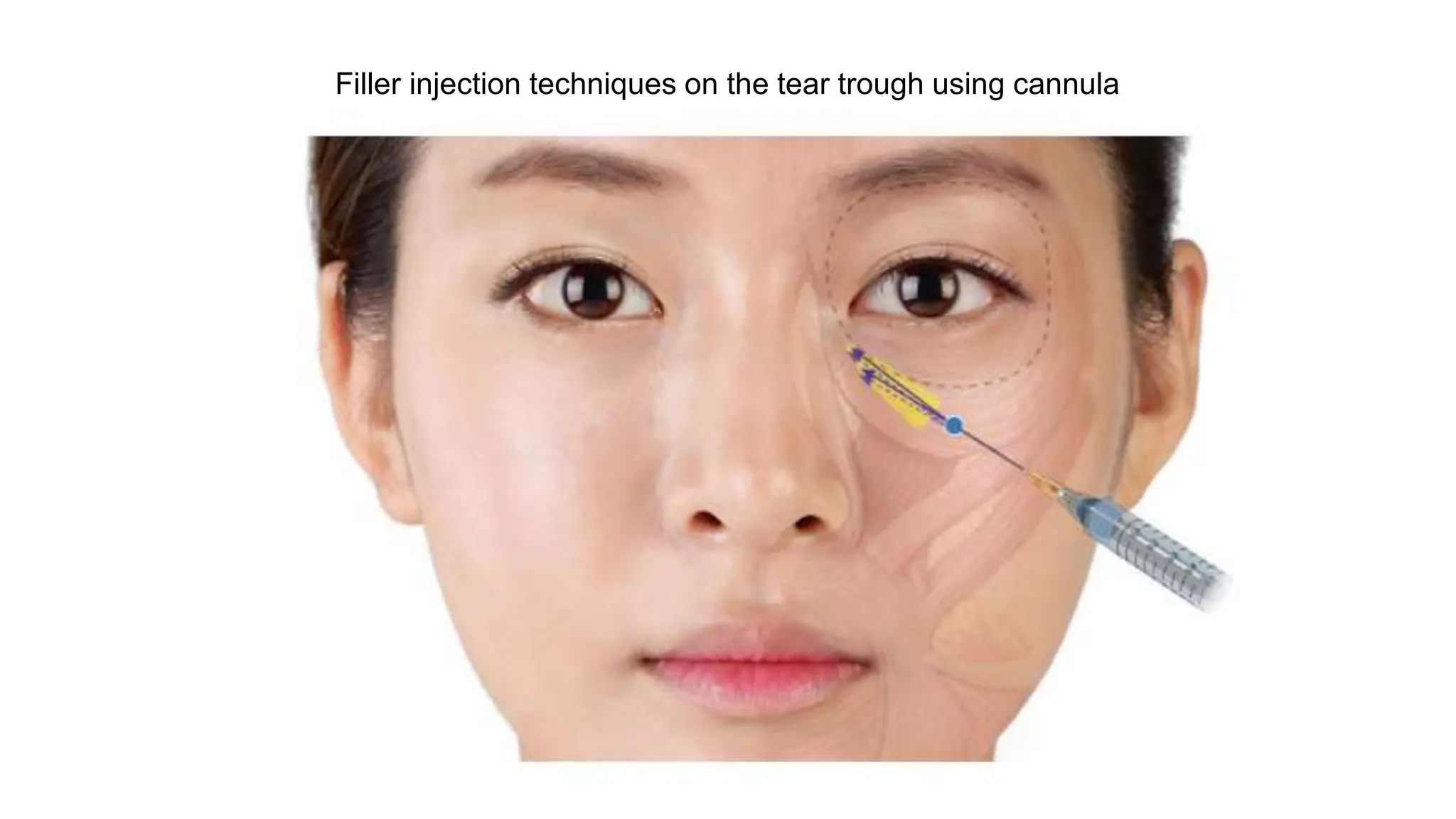 Basic Anatomy of the tear trough area .pptx