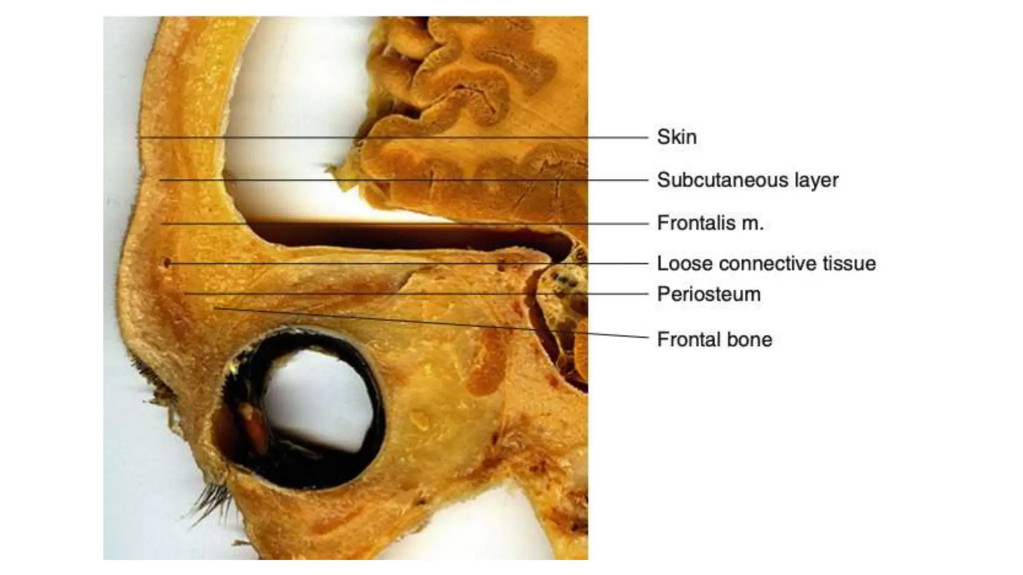 Basic Anatomy of the tear trough area .pptx