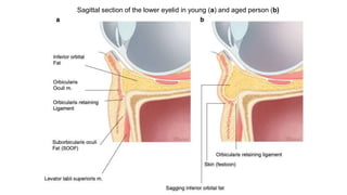 Basic Anatomy of the tear trough area .pptx
