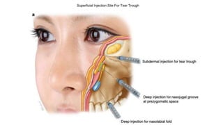 Basic Anatomy of the tear trough area .pptx