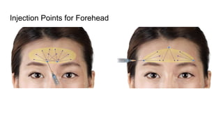 Basic Anatomy of the tear trough area .pptx