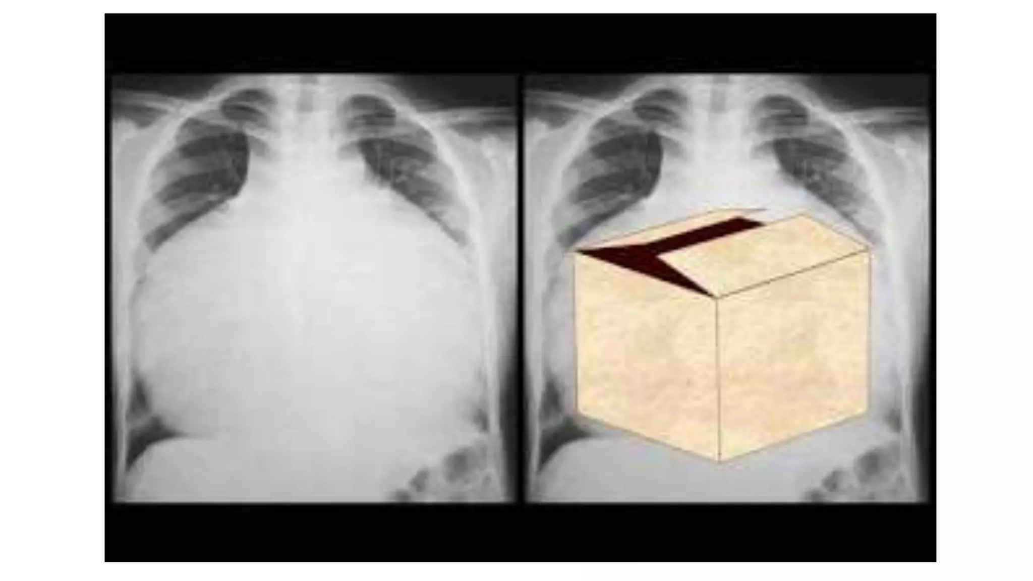 Basic Anatomy of Chest X Ray.pptx