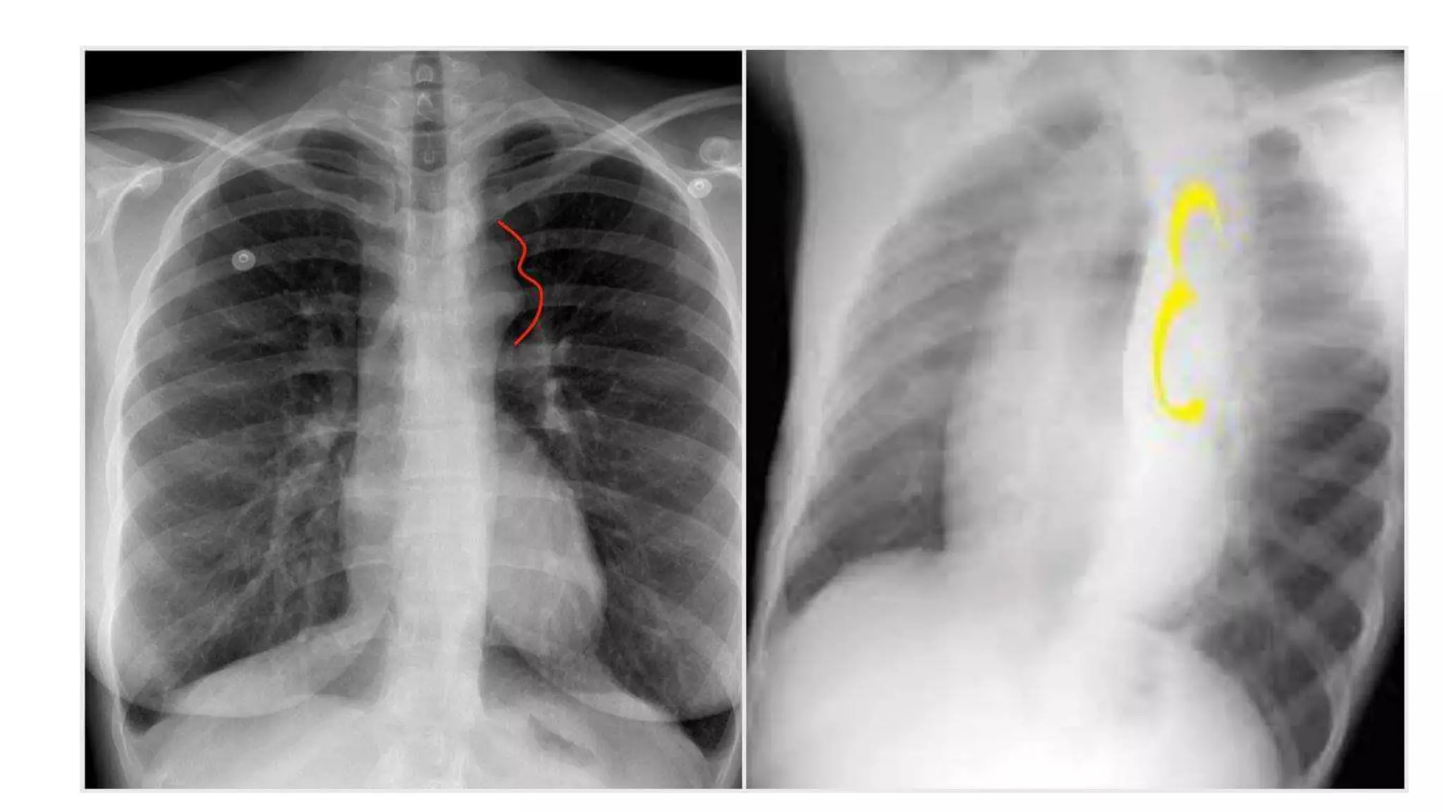 Basic Anatomy of Chest X Ray.pptx