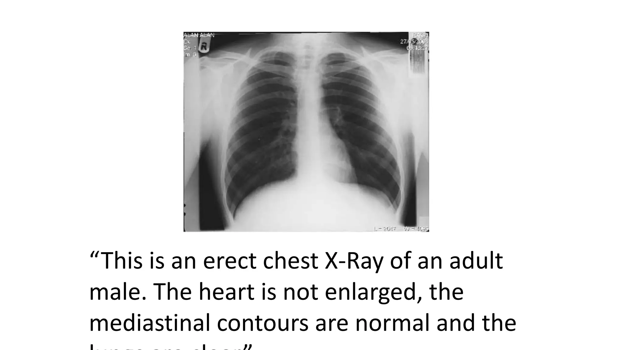 Basic Anatomy of Chest X Ray.pptx