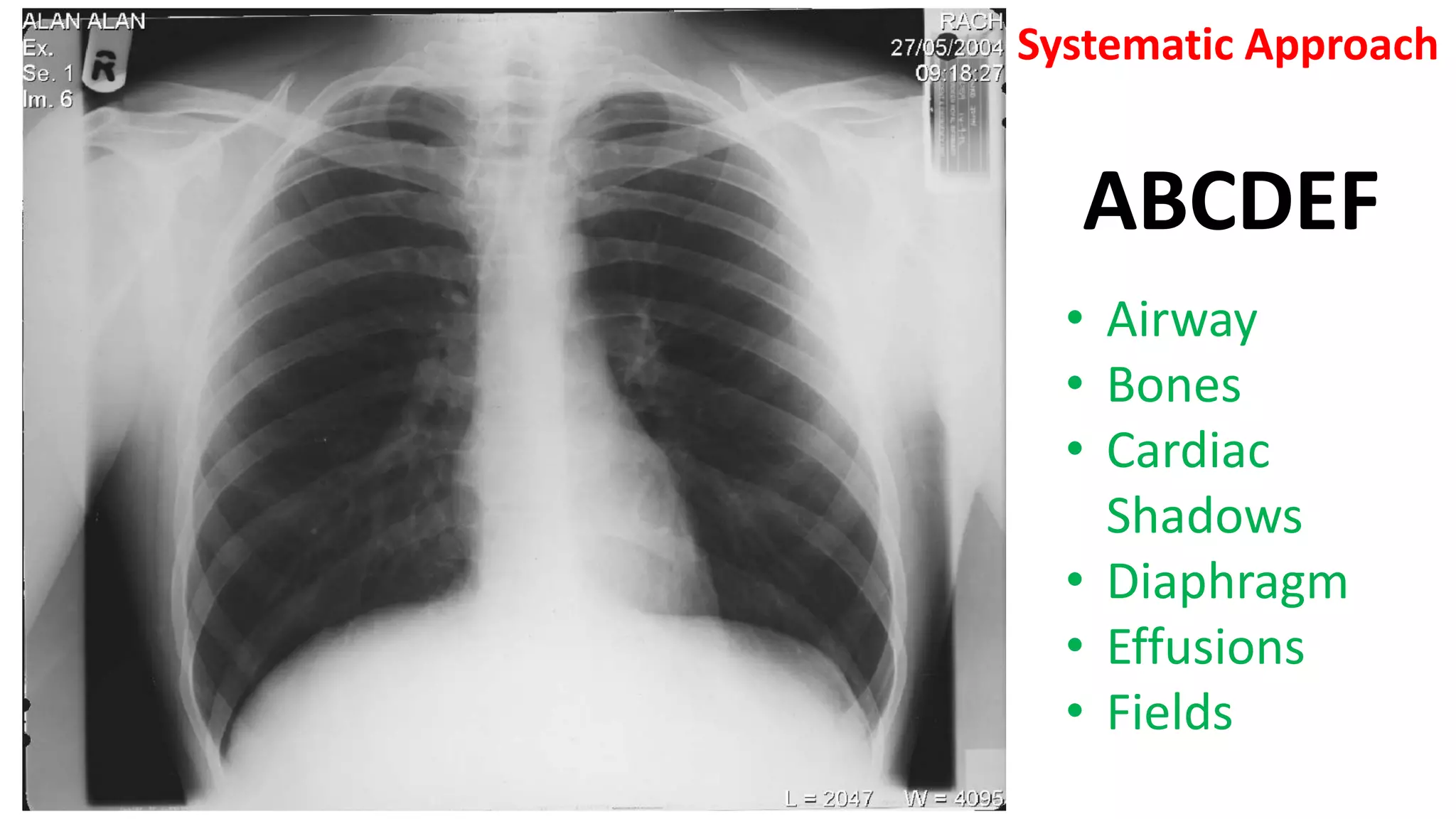 Basic Anatomy of Chest X Ray.pptx