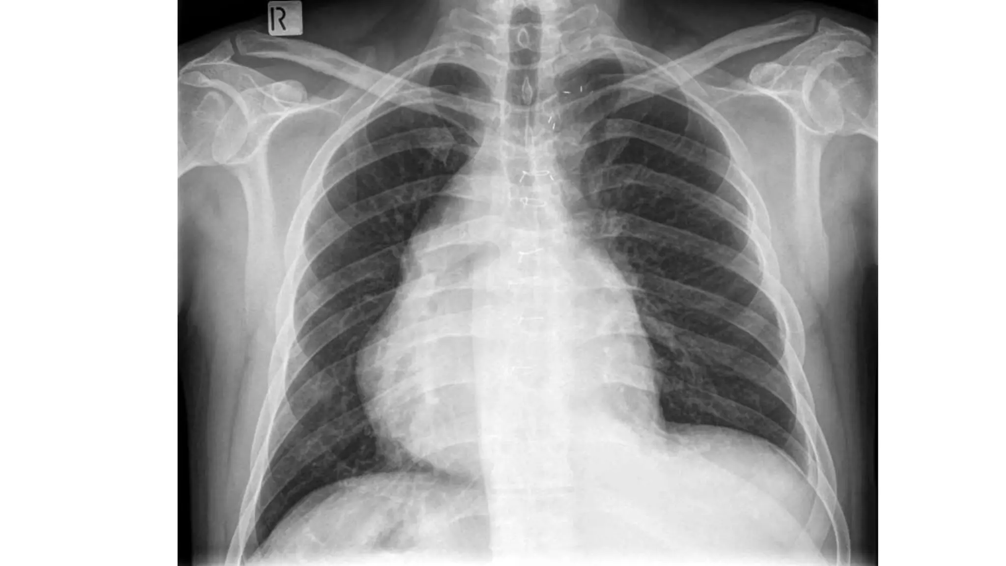 Basic Anatomy of Chest X Ray.pptx
