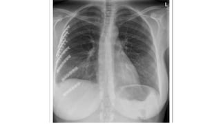 Basic Anatomy of Chest X Ray.pptx