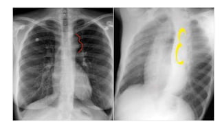 Basic Anatomy of Chest X Ray.pptx