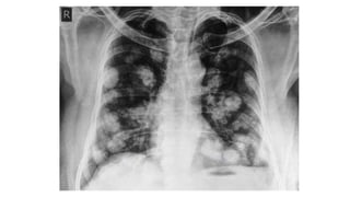 Basic Anatomy of Chest X Ray.pptx