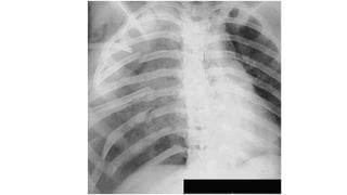 Basic Anatomy of Chest X Ray.pptx