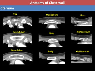 Basic anatomy & Radiology for breast cancer case | PPTX