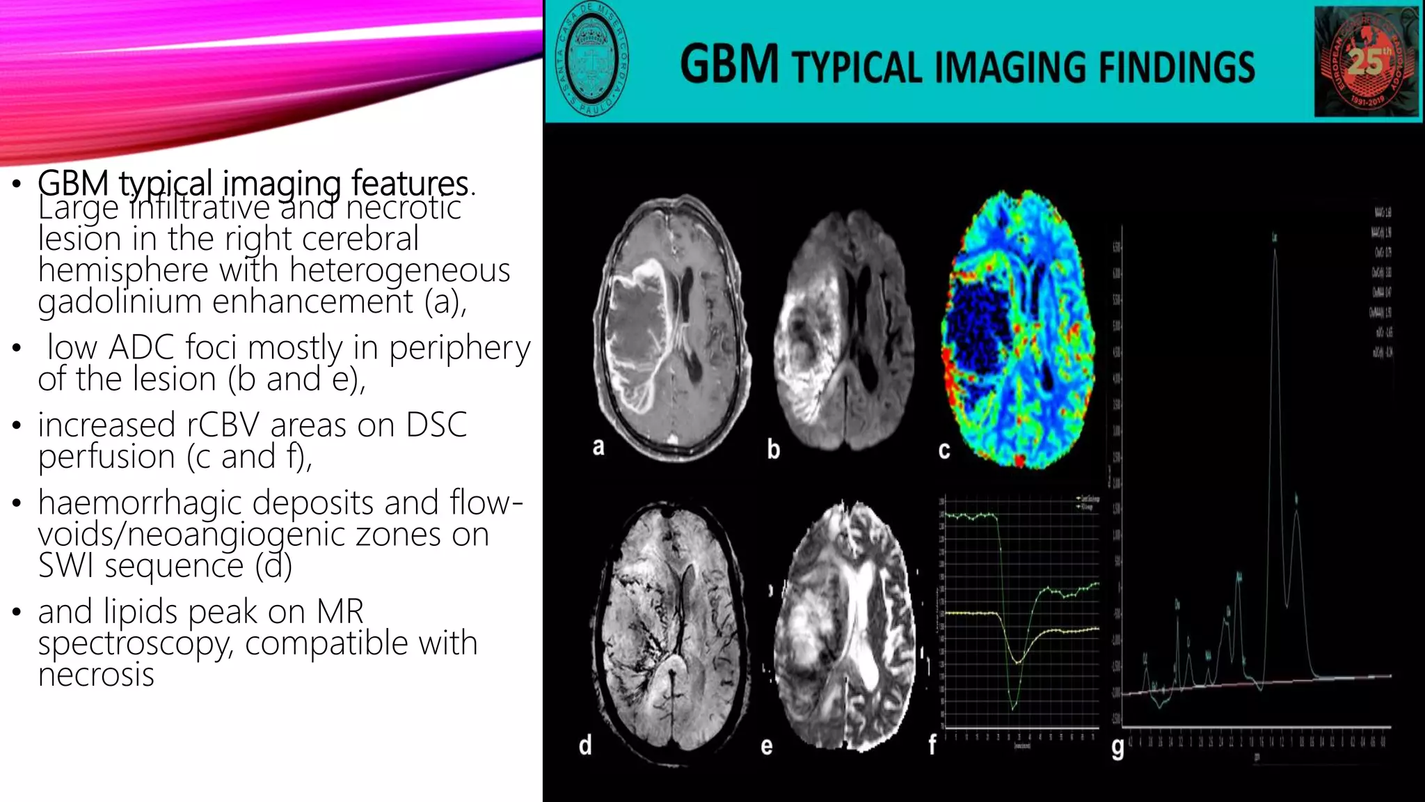 Basic and advanced imaging in adult gliomas | PPTX