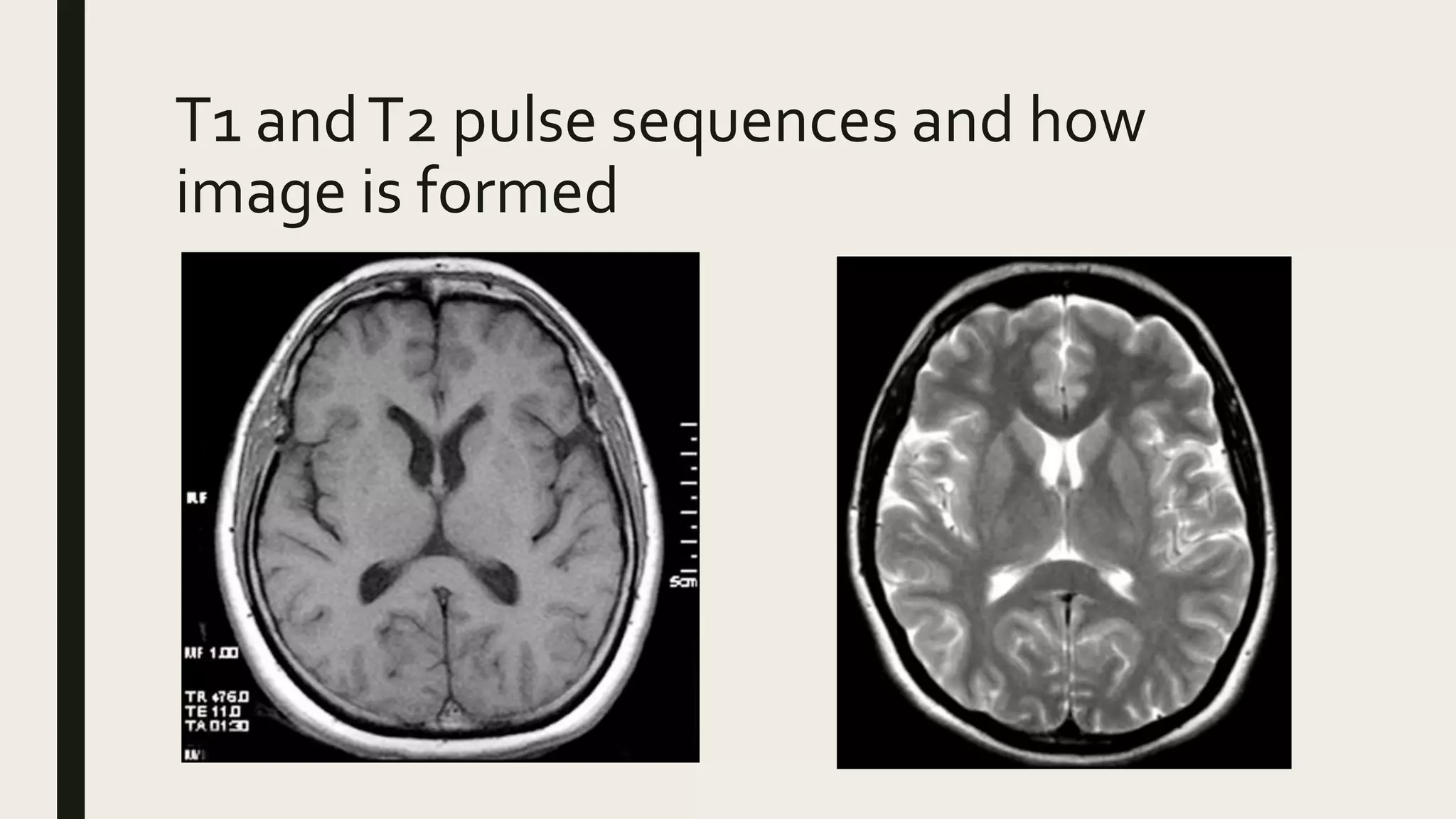 Basic and advanced mri imaging sequences in brain | PPTX