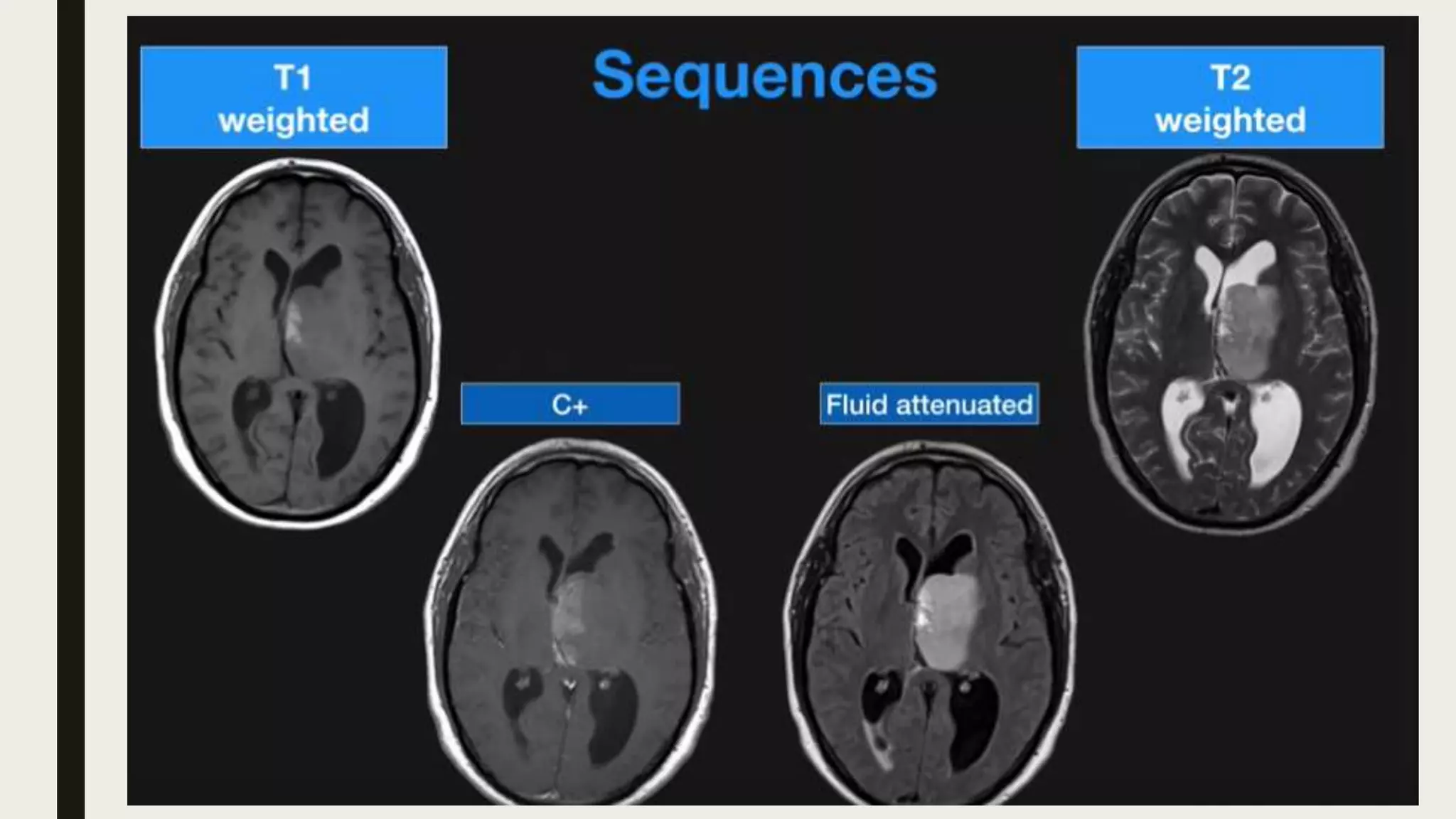Basic and advanced mri imaging sequences in brain | PPTX