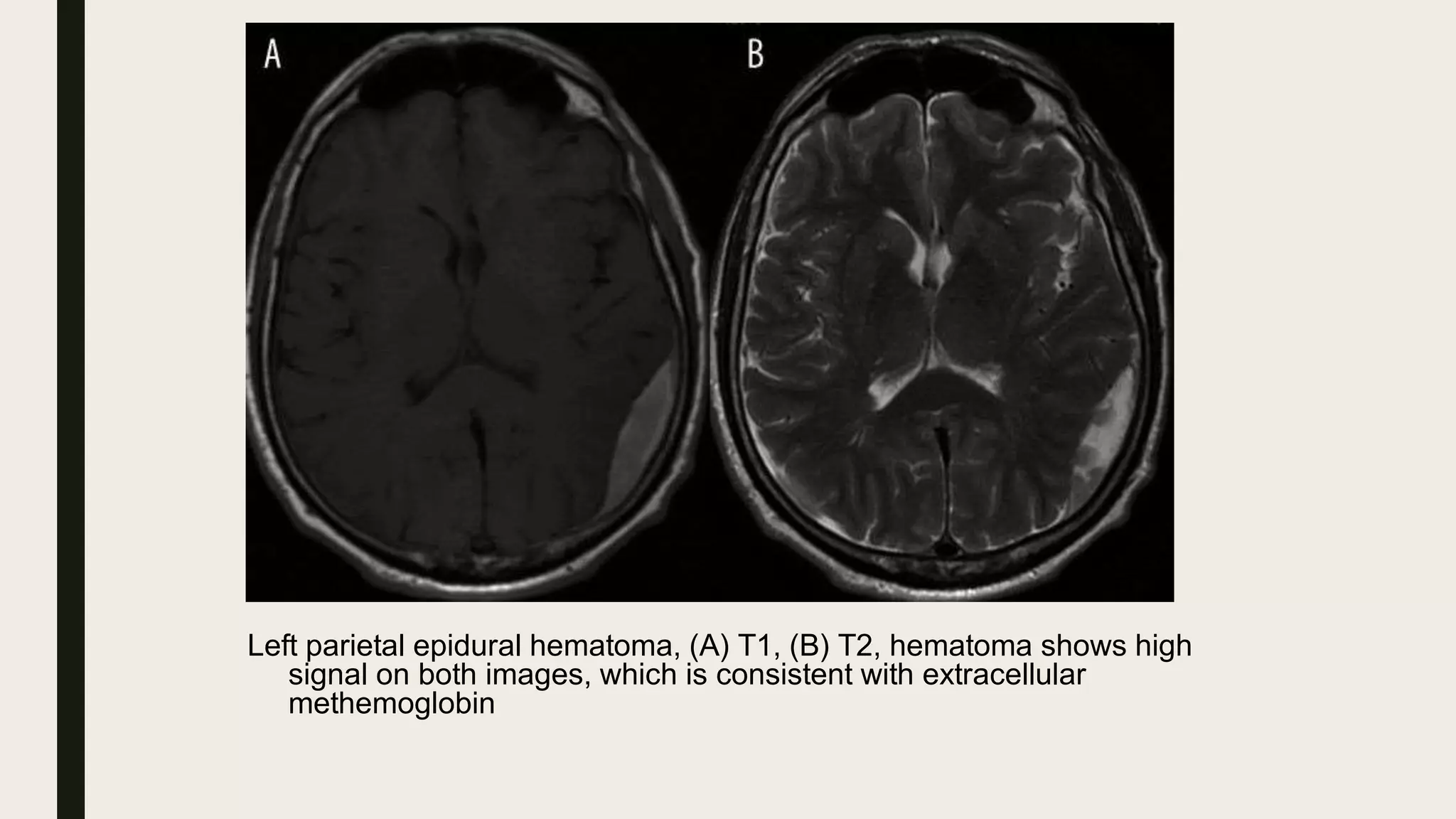 Basic and advanced mri imaging sequences in brain | PPTX