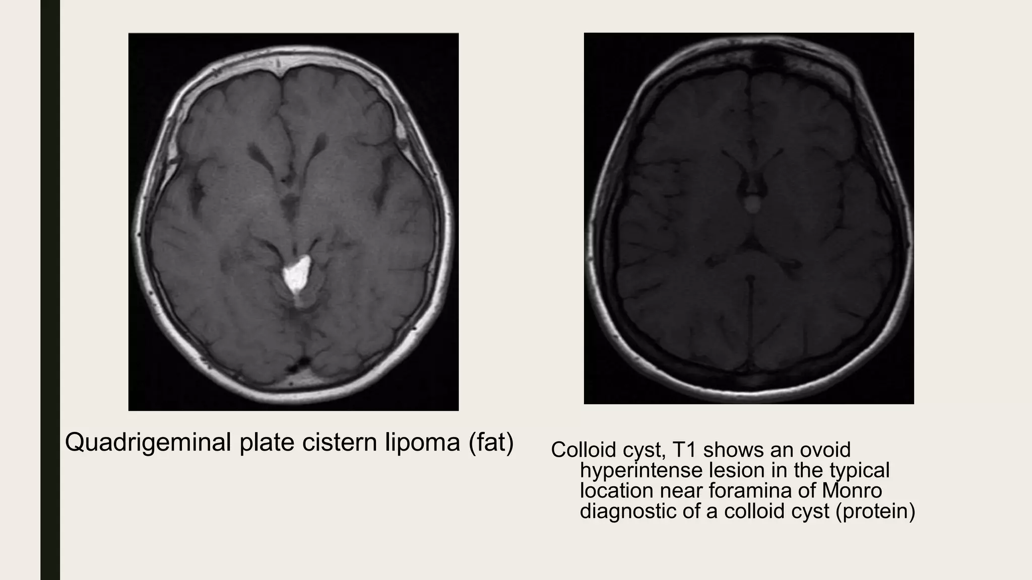 Basic and advanced mri imaging sequences in brain | PPTX