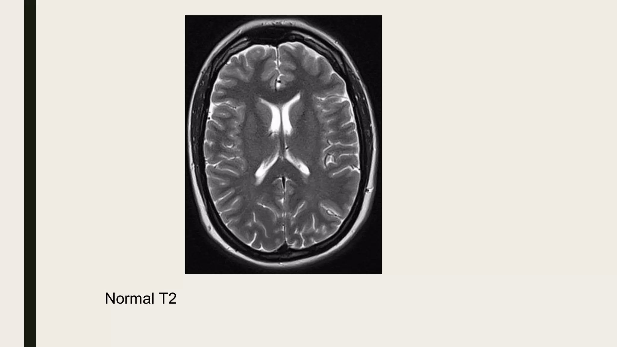 Basic and advanced mri imaging sequences in brain | PPTX