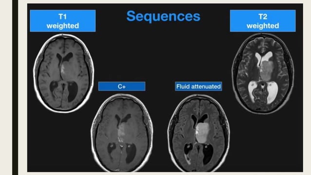 Basic and advanced mri imaging sequences in brain | PPTX