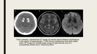 Basic and advanced mri imaging sequences in brain | PPTX