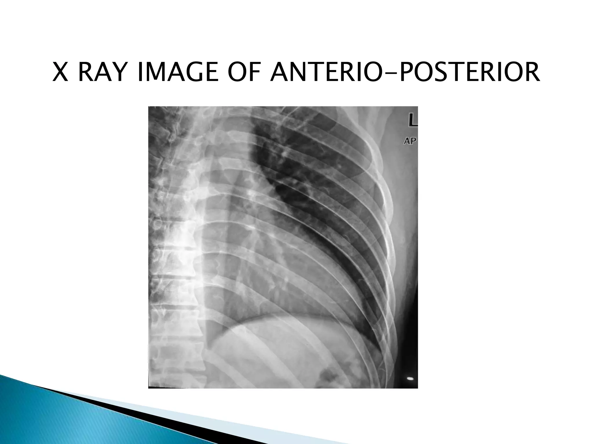 RIBS STERNUM X RAY PROJECTIONS . | PPTX