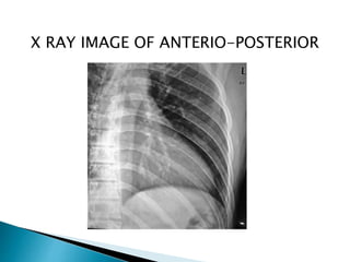 RIBS STERNUM X RAY PROJECTIONS . | PPTX