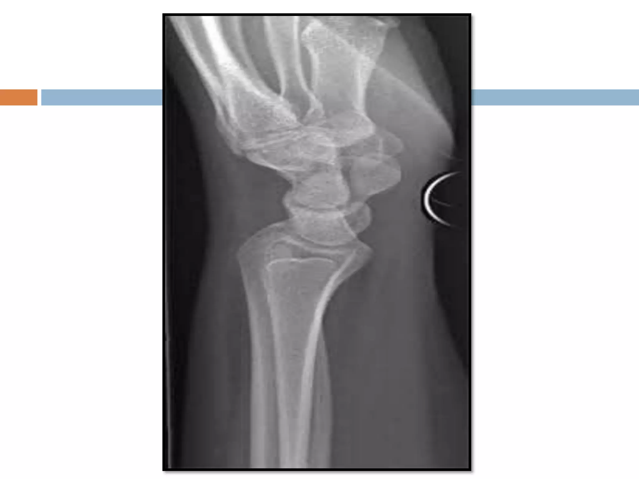Basic and supplementary projections of thumb and scaphoid | PPTX
