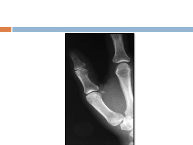 Basic and supplementary projections of thumb and scaphoid | PPTX