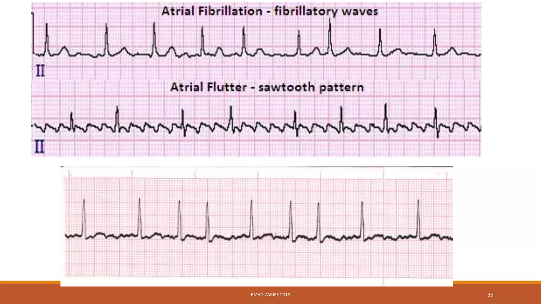 Basic anesthesia monitoring- Emad Zarief | PDF