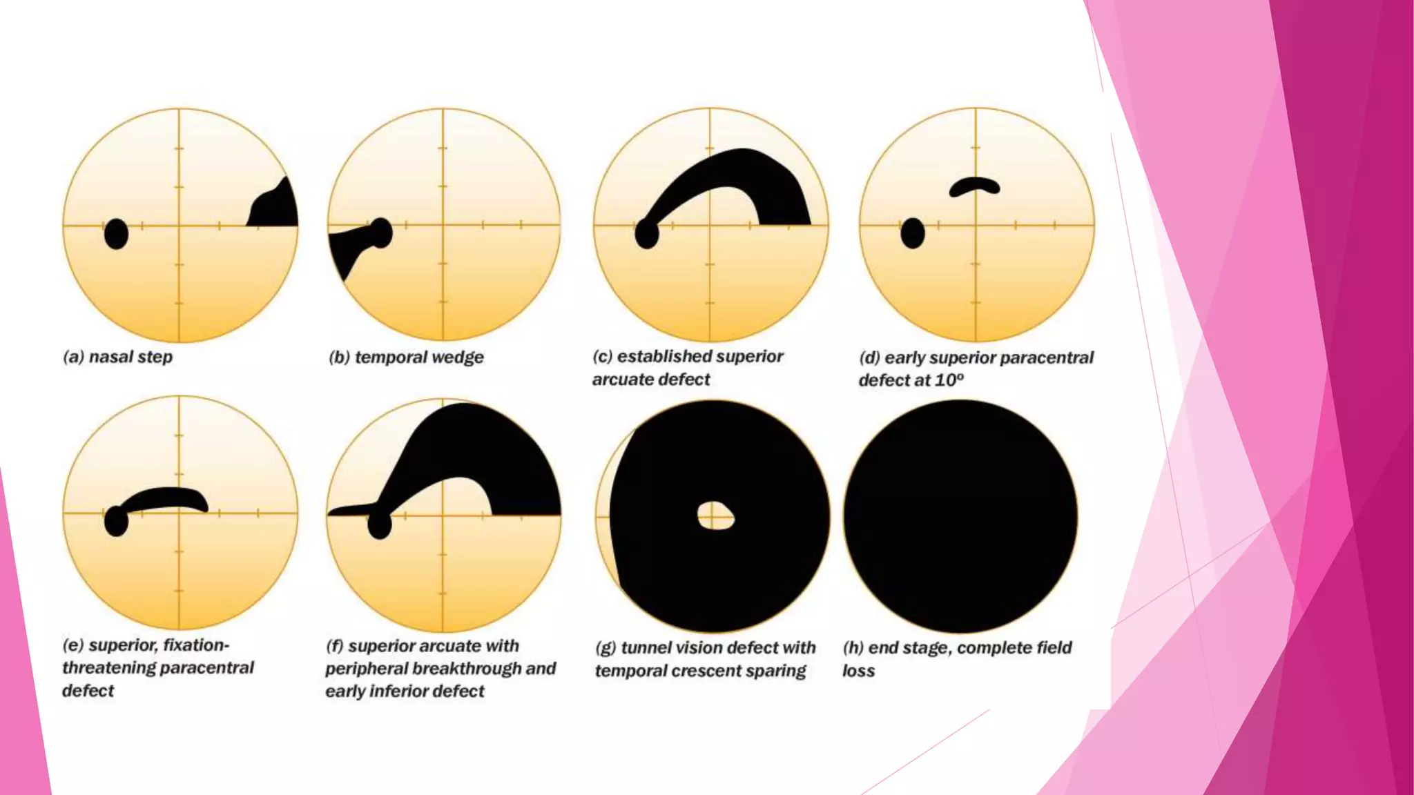 Basic approach on hvf | PPTX