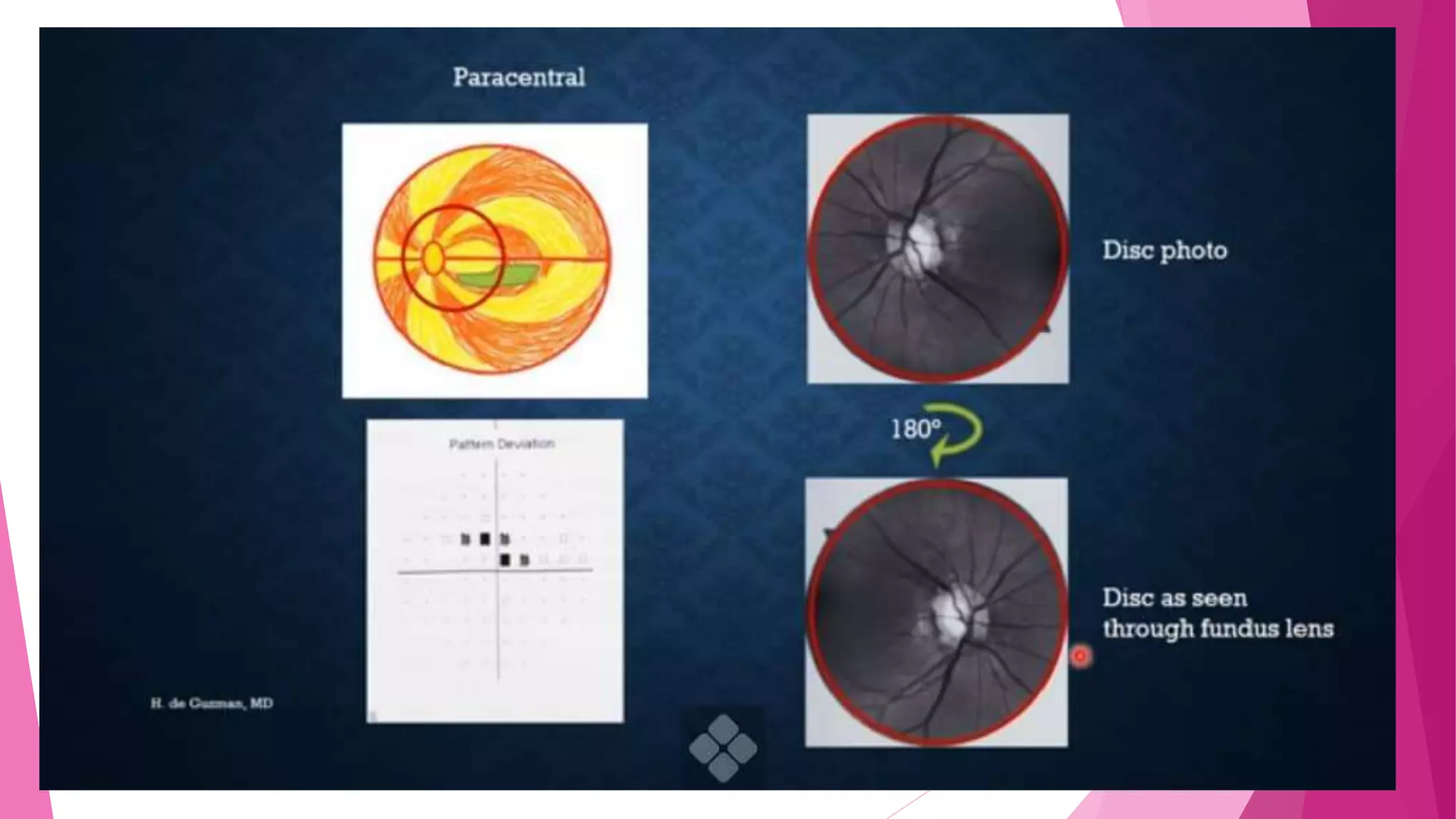 Basic approach on hvf | PPTX